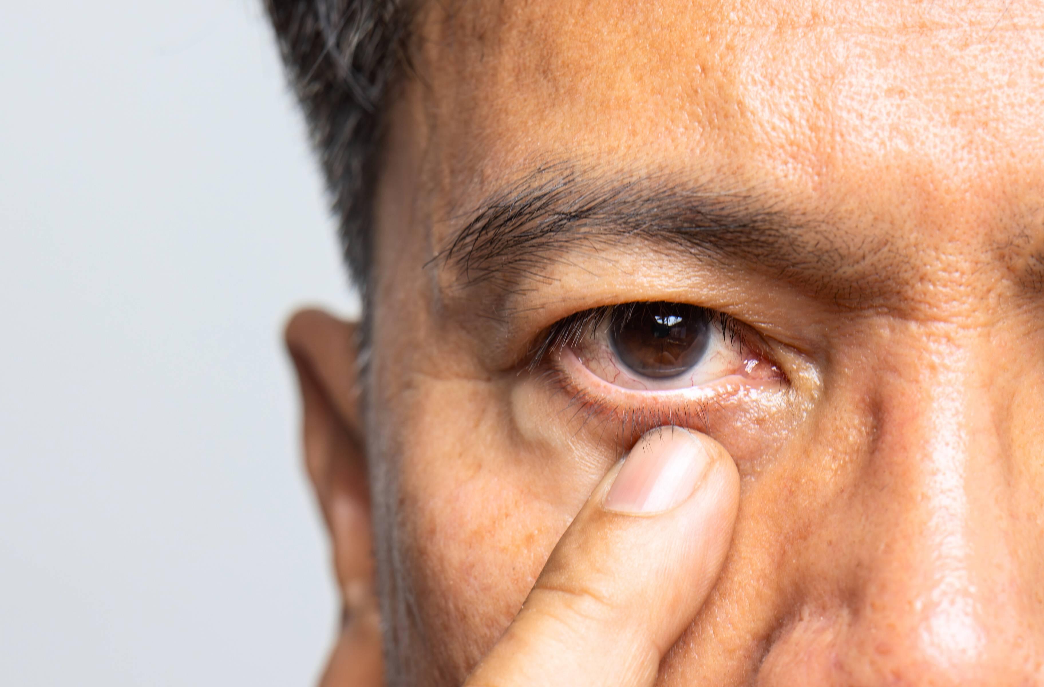 Bell's palsy: How does it affect the eyes? – Iris