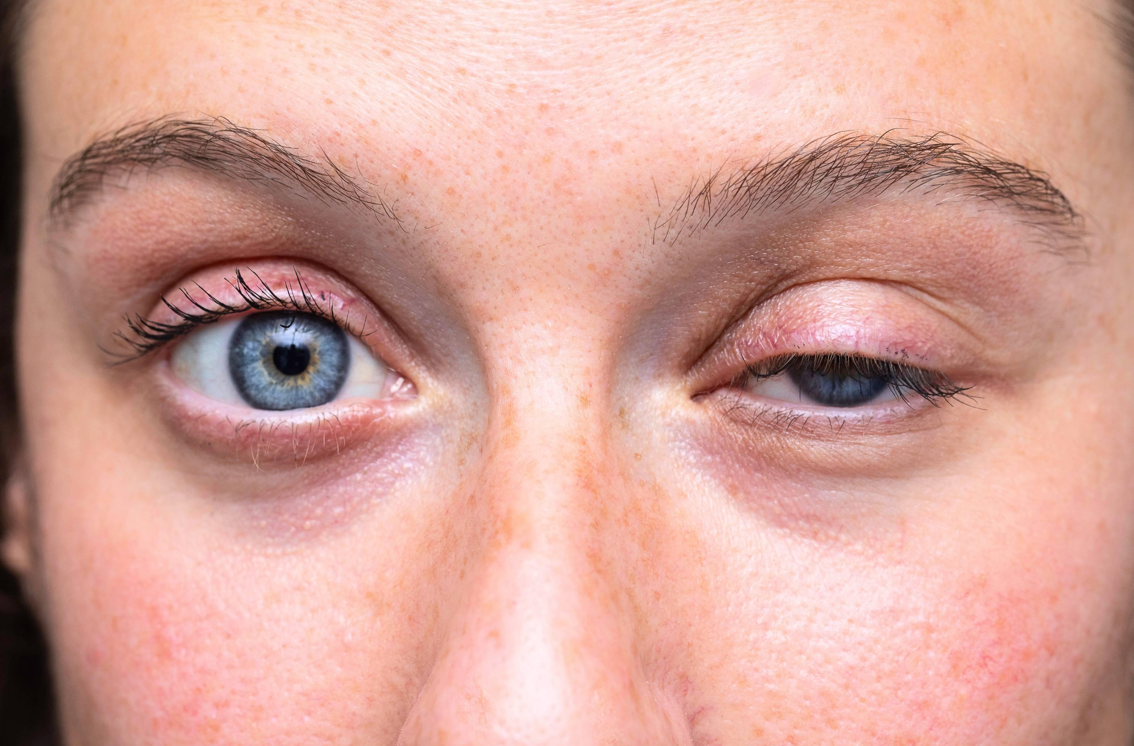Swollen Eyelids: Causes and Solutions – Iris