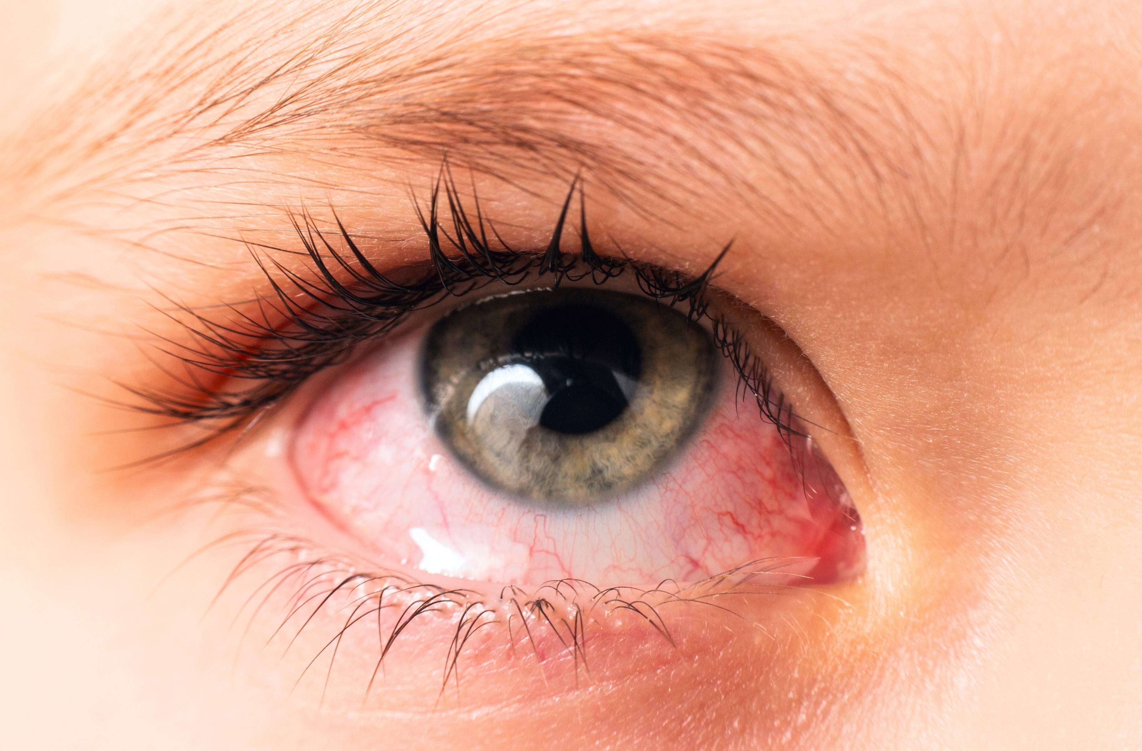 How to Manage Infectious Conjunctivitis? – Iris