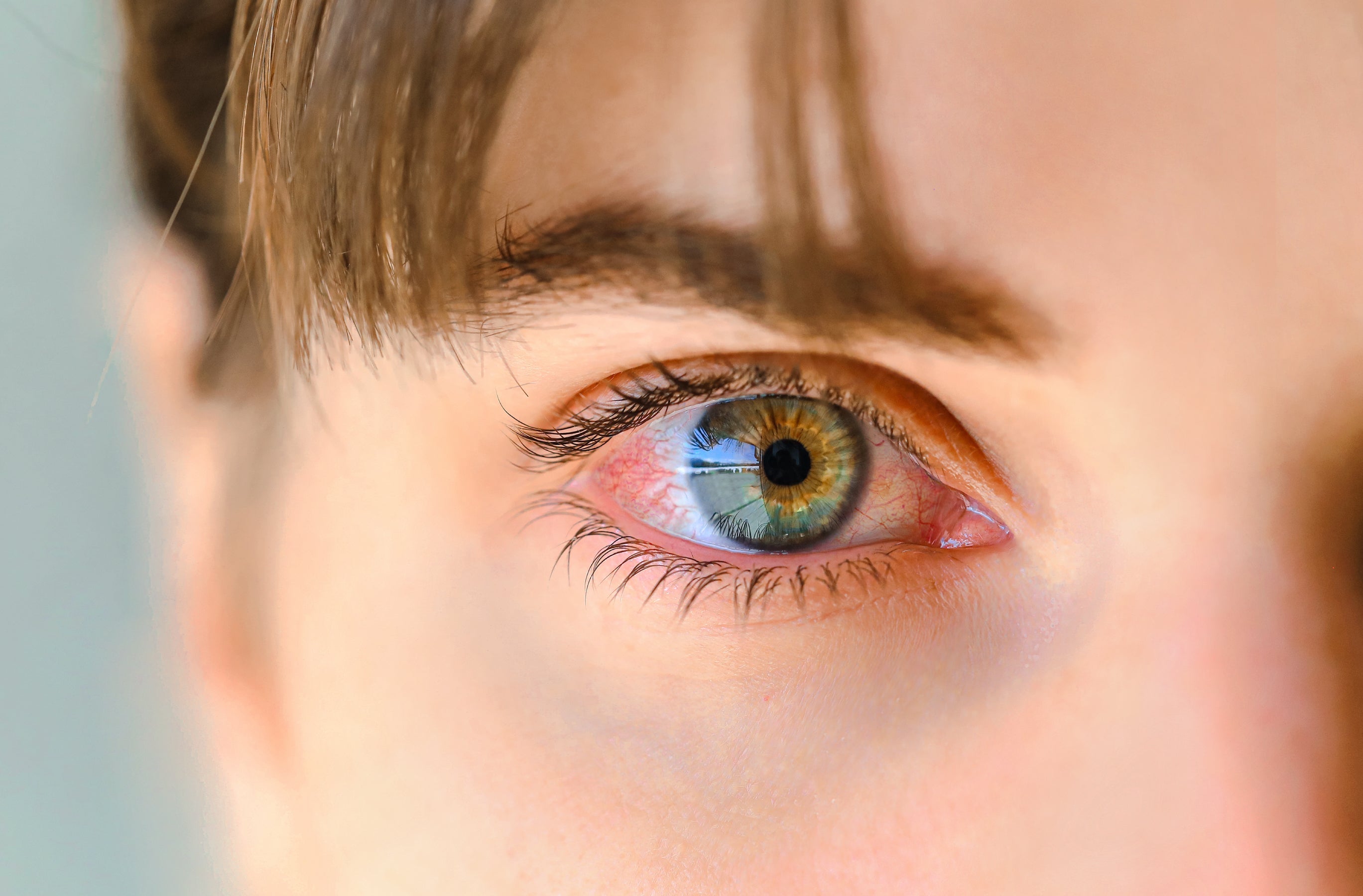 How eye infections can cause puffy eyes – Iris
