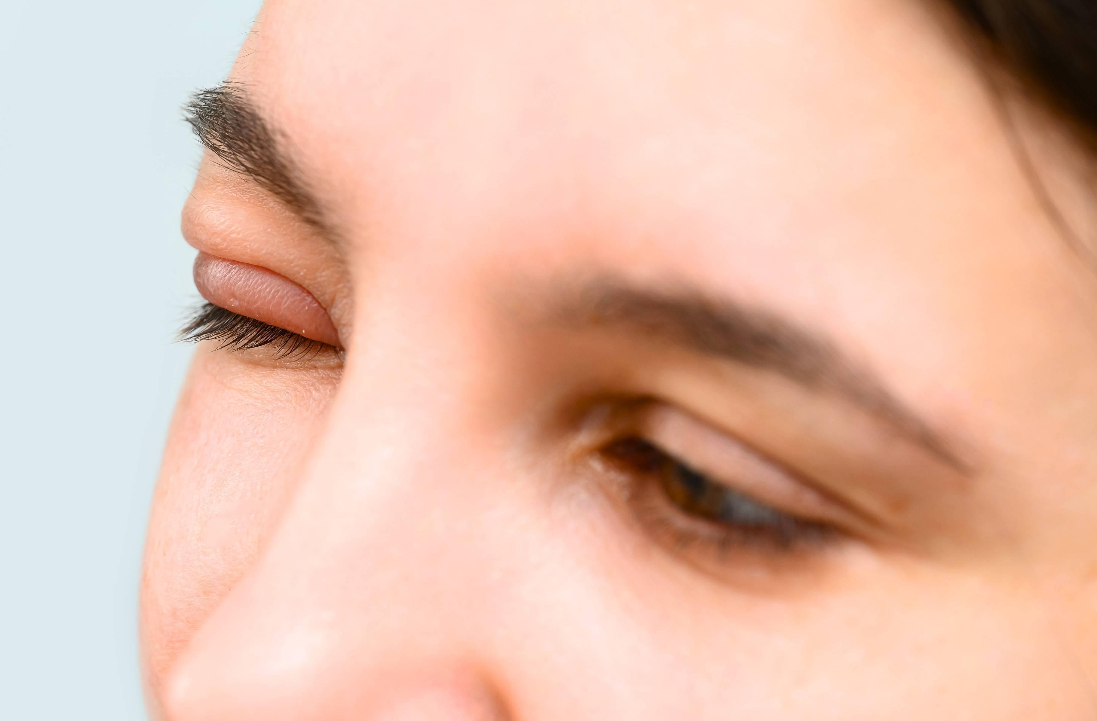 What is Orbital Cellulitis? – Iris