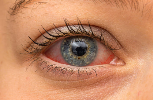 Uvéite: causes, symptômes et traitements – Iris