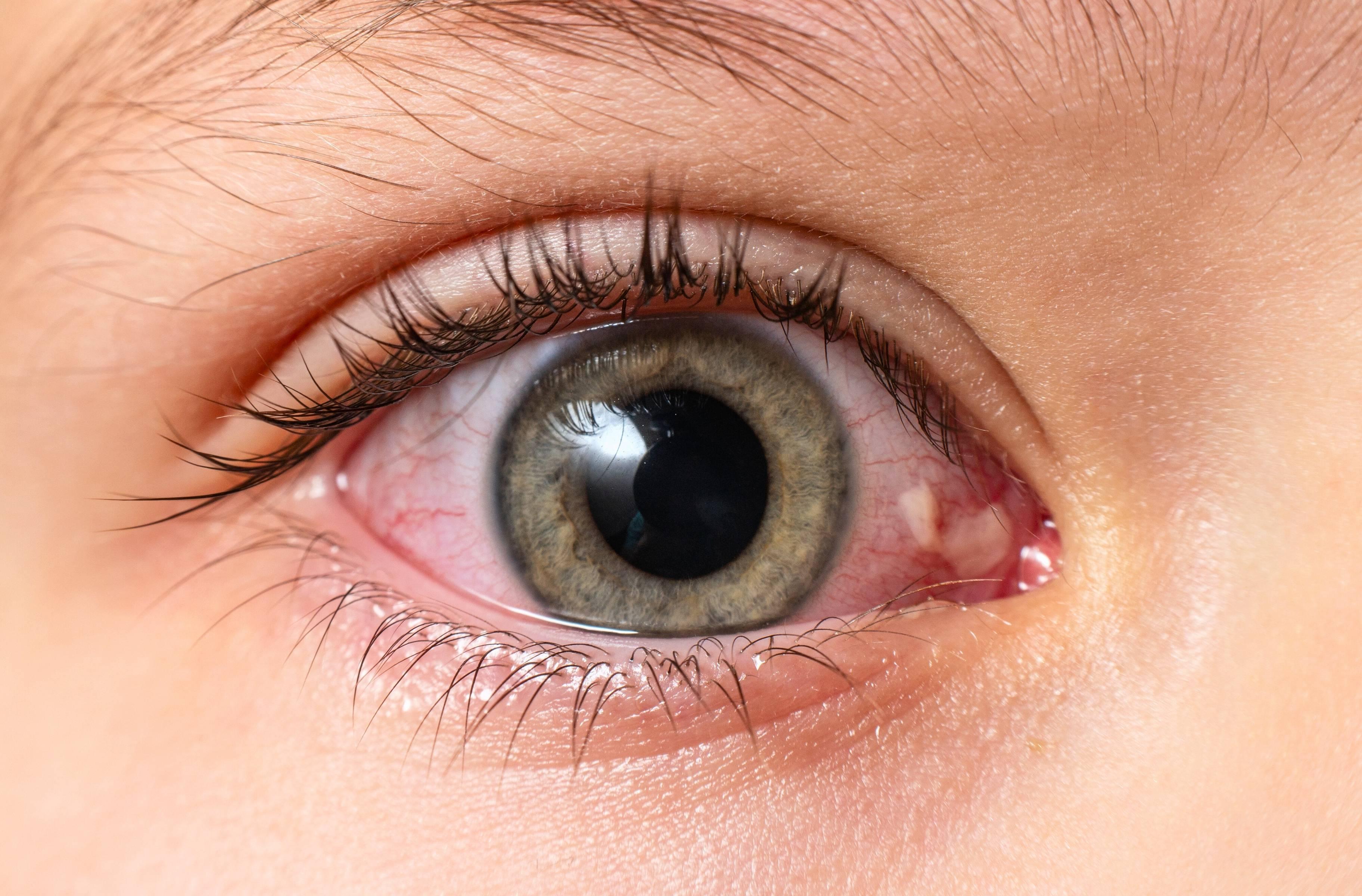 Yeux rouges : causes, symptômes et traitements – Iris