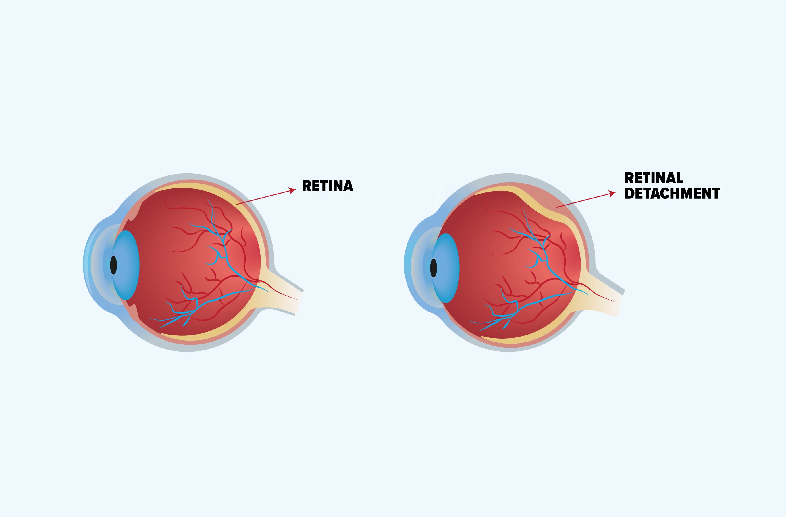 Comprendre le décollement de la rétine – Iris