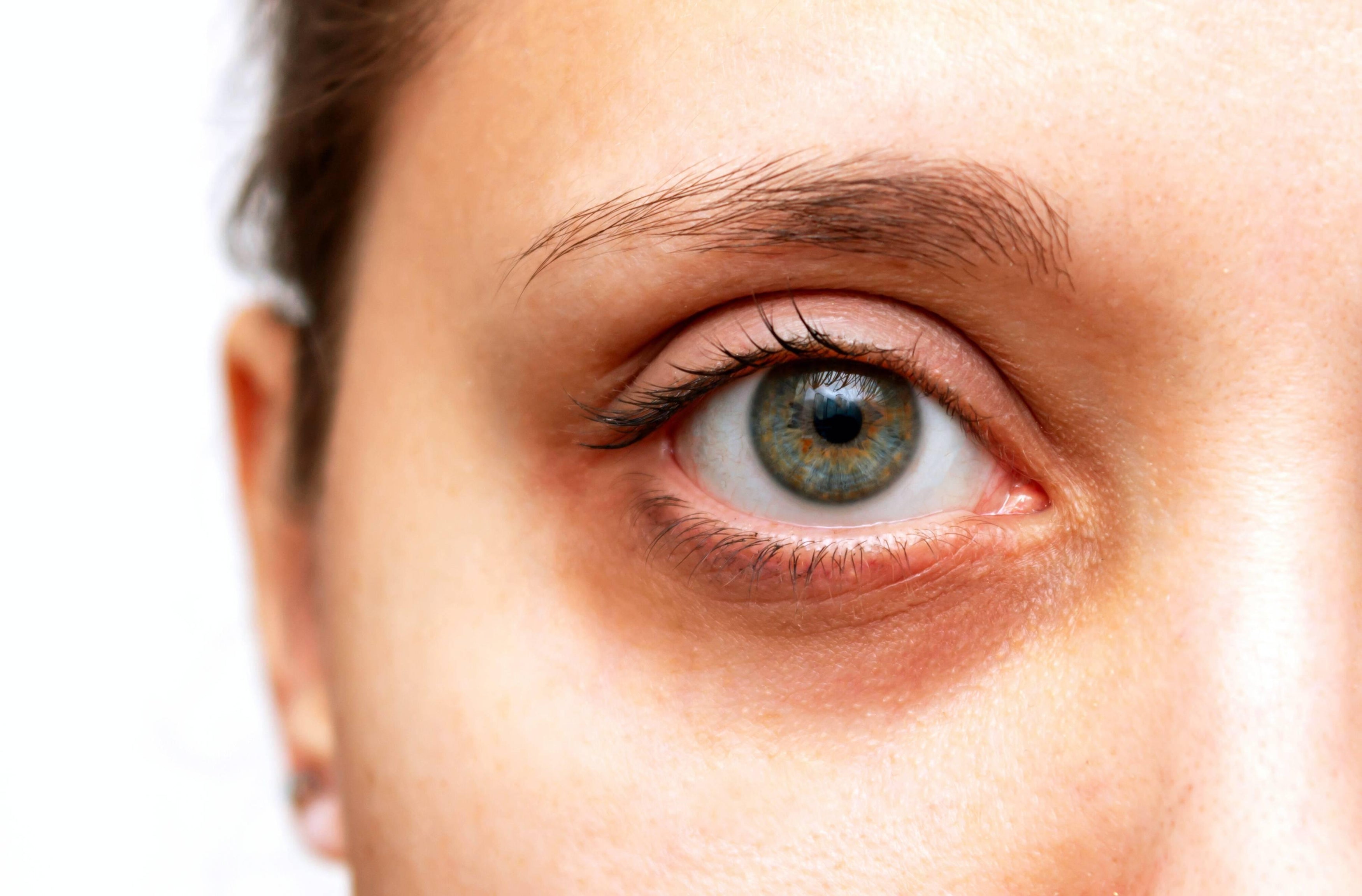 Cernes sous les yeux: causes et comment s'en débarrasser? – Iris