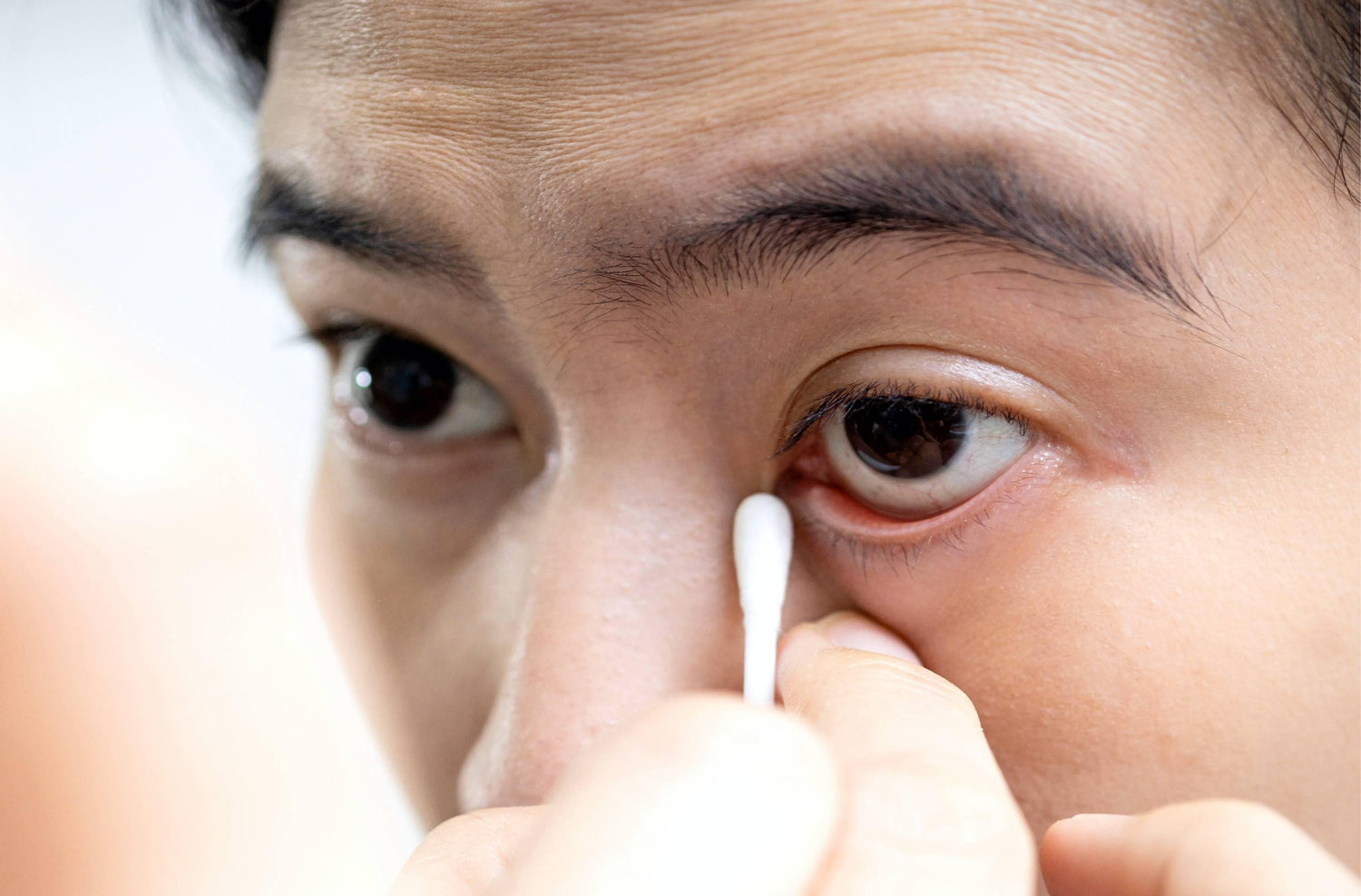 Ectropion and Entropion of The Eye: Causes, Symptoms and Treatment – Iris