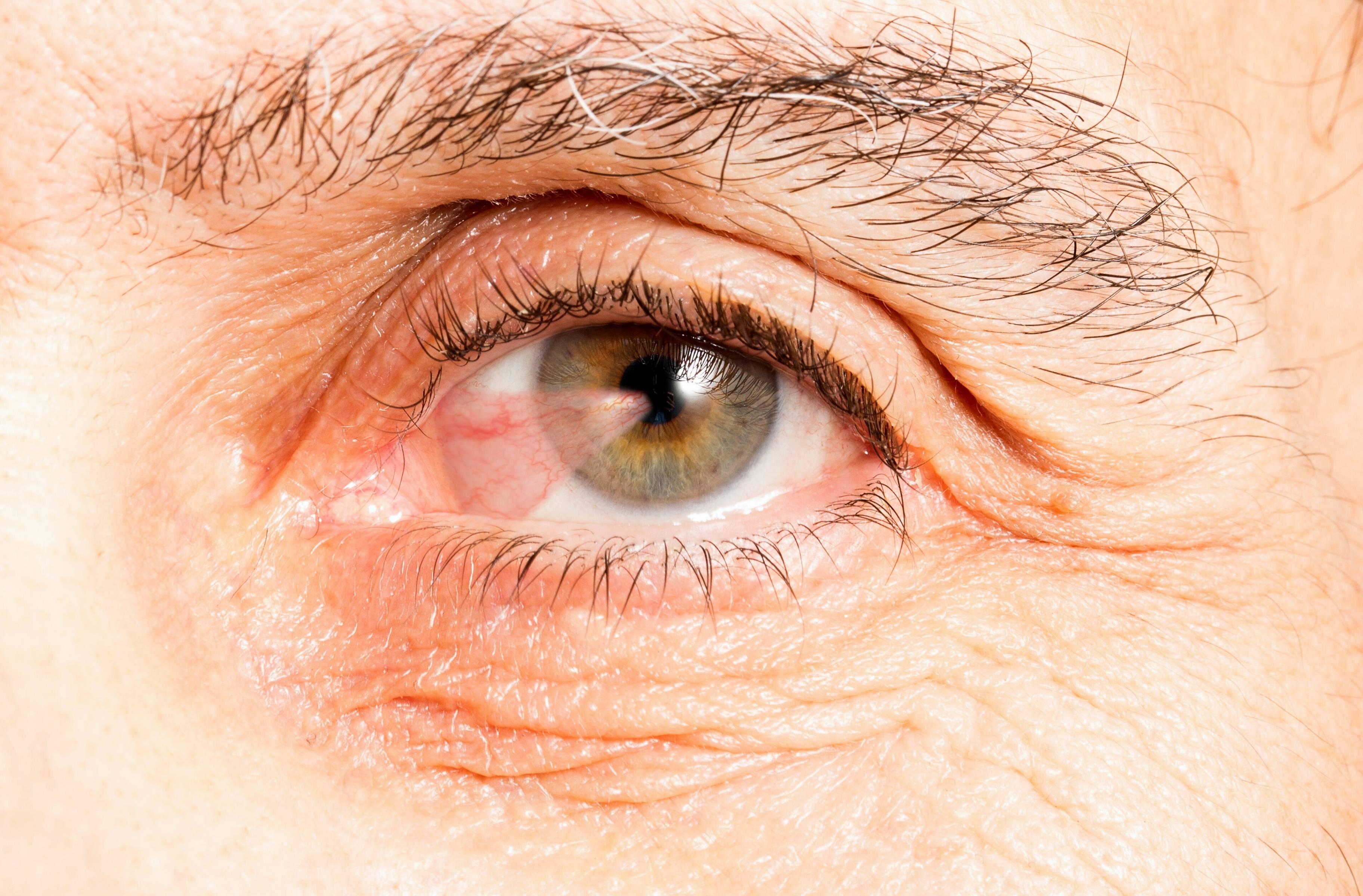 What Are Pinguecula and Pterygium? How Do You Treat Them? – Iris