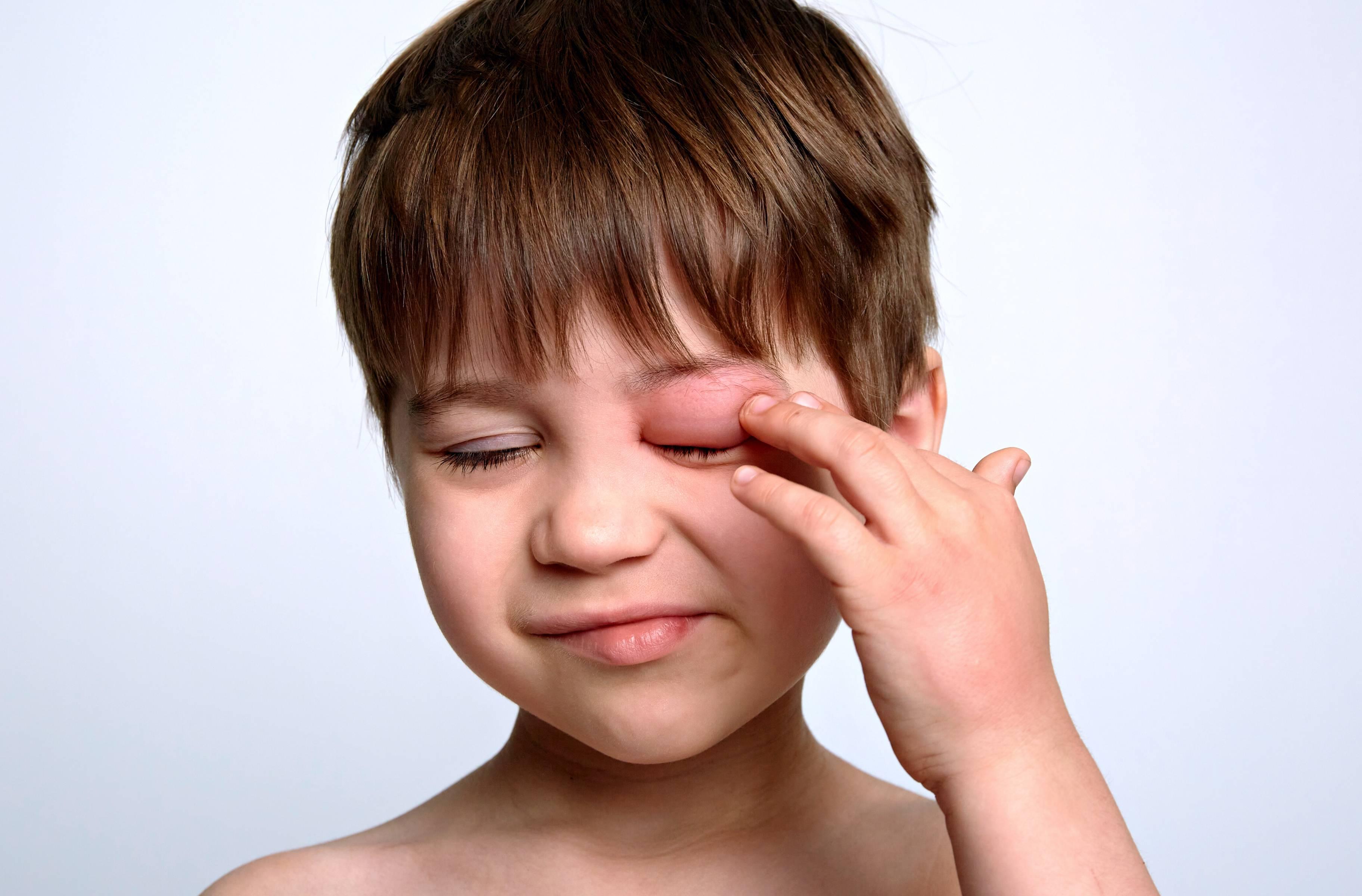 What is preseptal cellulitis? – Iris